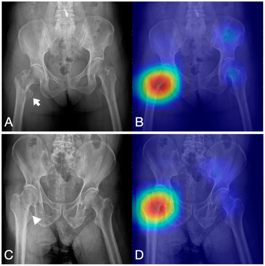 The Application of Design Thinking in Developing a Deep Learning Algorithm for Hip Fracture ...