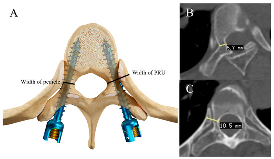 Using a 3D Navigation Template to Increase the Accuracy of Thoracic ...