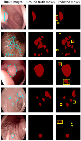 Semantic Segmentation of Gastric Polyps in Endoscopic Images Based on Convolutional Neural ...