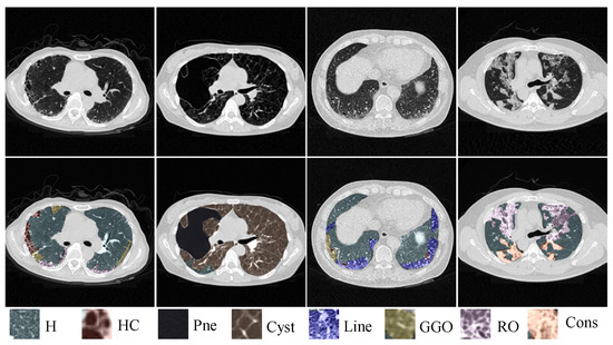 Semi-Supervised Segmentation of Interstitial Lung Disease Patterns from ...