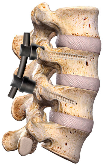 Carbon Fiber-Reinforced PolyEtherEtherKetone (CFR-PEEK) Instrumentation ...