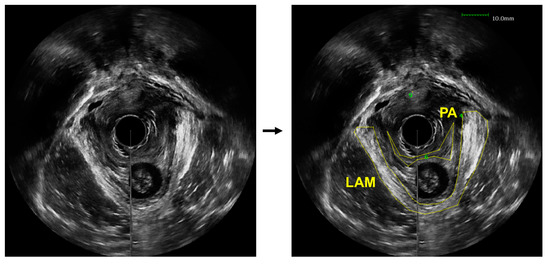 Automated Segmentation of Levator Ani Muscle from 3D Endovaginal ...