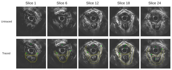 Automated Segmentation of Levator Ani Muscle from 3D Endovaginal ...