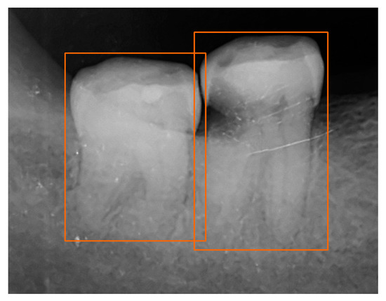 Deep Learning-Based Recognition of Periodontitis and Dental Caries in ...