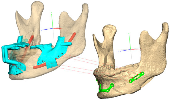 Bioengineering | Free Full-Text | Clinical Stability of Bespoke Snowman ...
