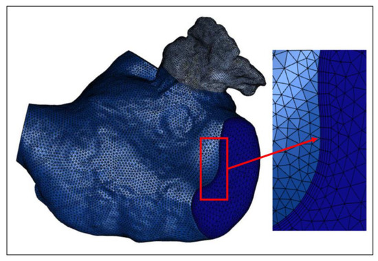 Research on the Internal Flow Field of Left Atrial Appendage and Stroke ...