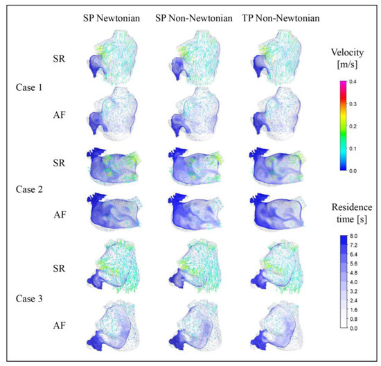 Research on the Internal Flow Field of Left Atrial Appendage and Stroke ...