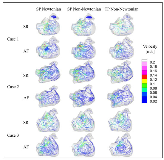 Research on the Internal Flow Field of Left Atrial Appendage and Stroke ...