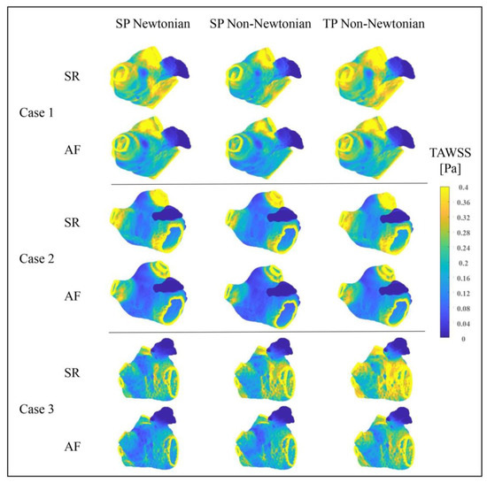 Research on the Internal Flow Field of Left Atrial Appendage and Stroke ...