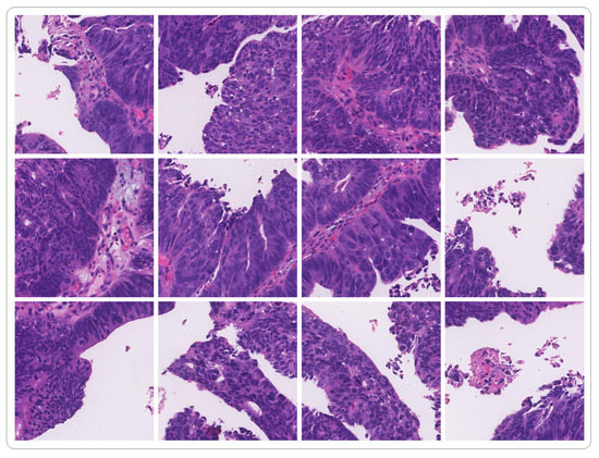 RGSB-UNet: Hybrid Deep Learning Framework for Tumour Segmentation in Digital Pathology Images