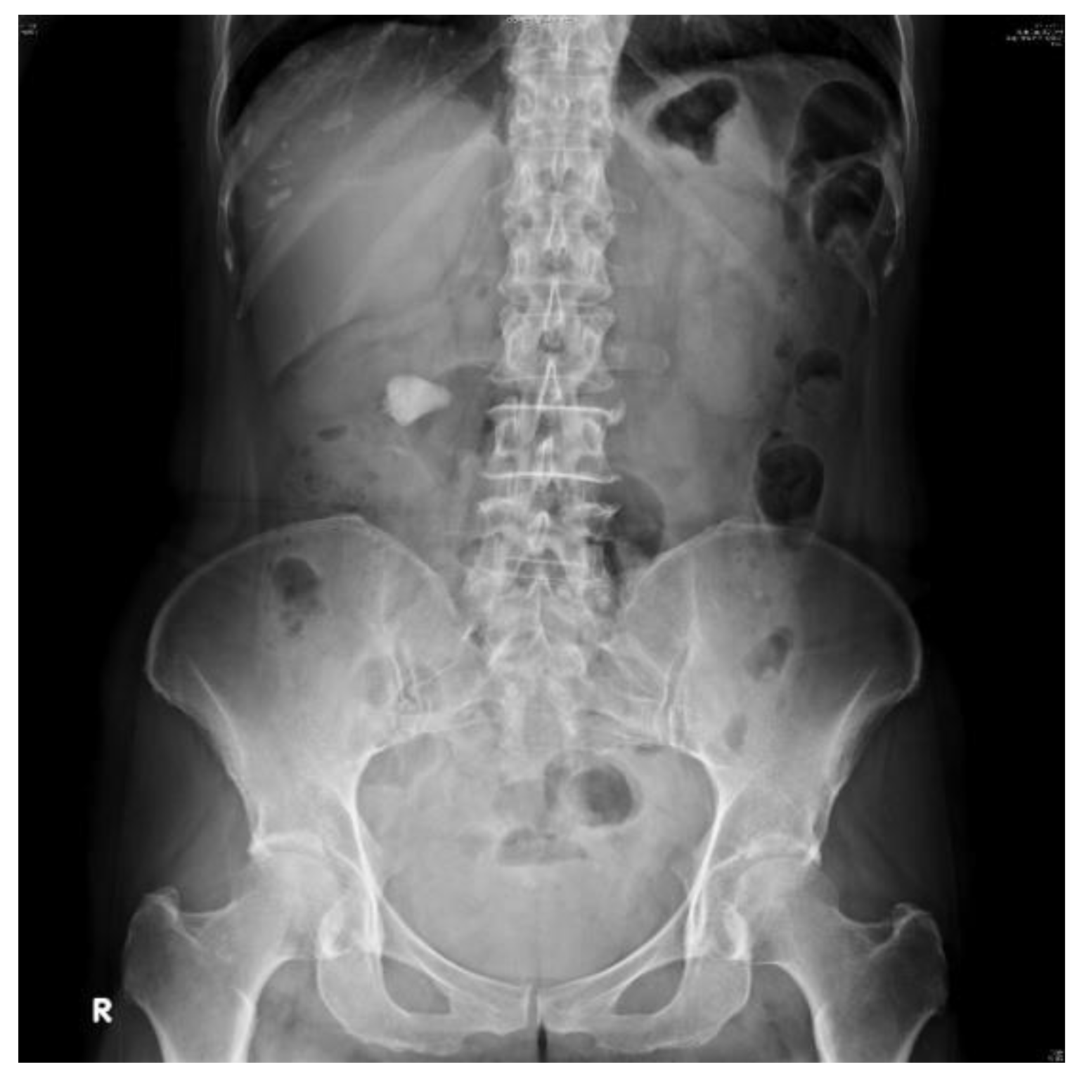 Design and Validation of a Deep Learning Model for Renal Stone Detection and Segmentation on ...