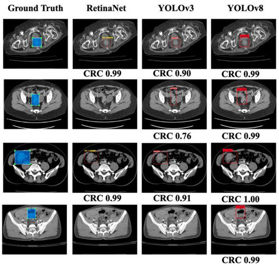 Localization of Colorectal Cancer Lesions in Contrast-Computed ...