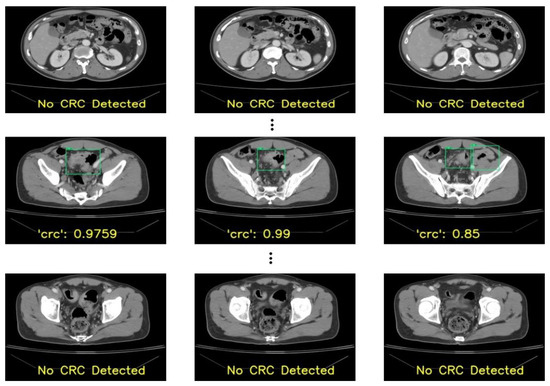 Localization of Colorectal Cancer Lesions in Contrast-Computed ...