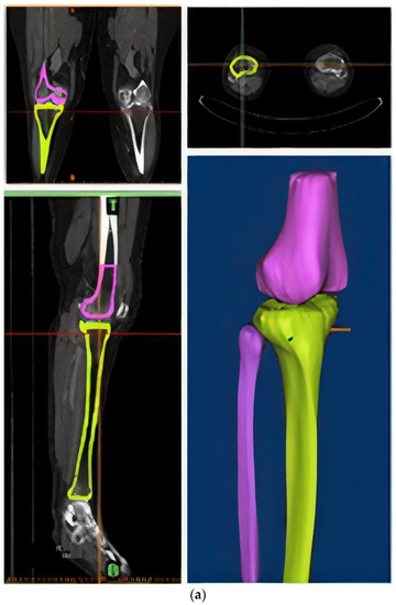 Stress Effect in the Knee Joint Based on the Fibular Osteotomy Level ...