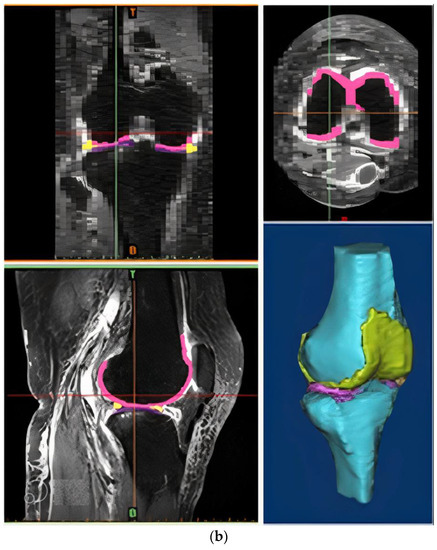 Stress Effect in the Knee Joint Based on the Fibular Osteotomy Level ...
