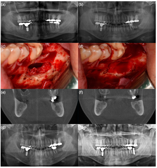 Current Status of Recombinant Human Bone Morphogenetic Protein-2 (rhBMP ...