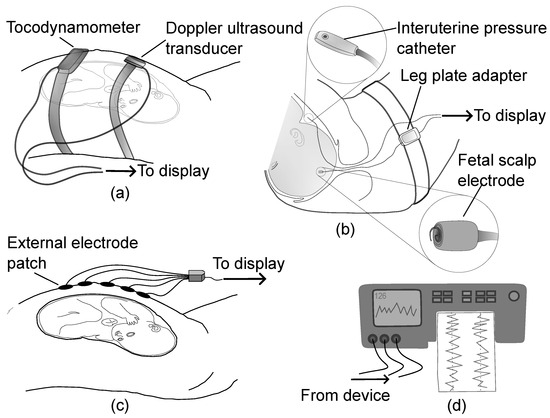 Bioengineering | Free Full-Text | Computerised Cardiotocography Analysis for the Automated ...