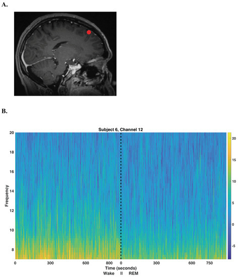 Bioengineering | Free Full-Text | Unsupervised Multitaper Spectral Method for Identifying REM ...