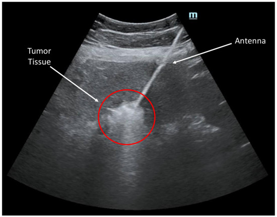 Emprint Microwave Thermoablation System: Bridging Thermal Ablation ...