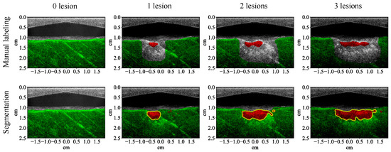 Deep-Learning-Based High-Intensity Focused Ultrasound Lesion Segmentation in Multi-Wavelength ...