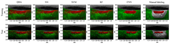Deep-Learning-Based High-Intensity Focused Ultrasound Lesion ...