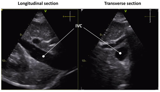 Processing Ultrasound Scans of the Inferior Vena Cava: Techniques and ...