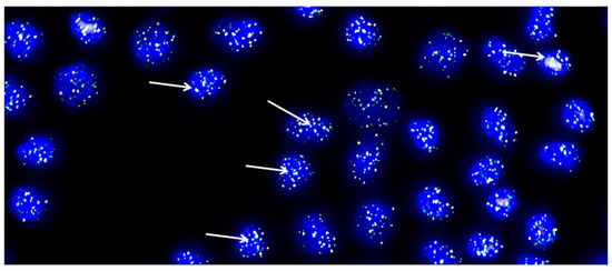Cartilage Defect Treatment Using High-Density Autologous Chondrocyte ...