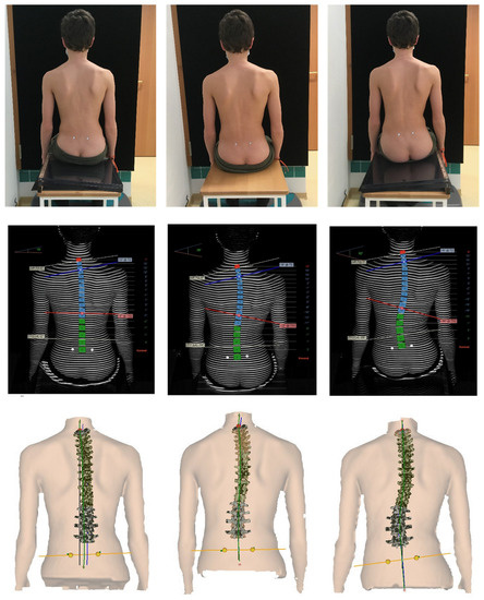Influence of Lateral Sitting Wedges on the Rasterstereographically Measured Scoliosis Angle in ...