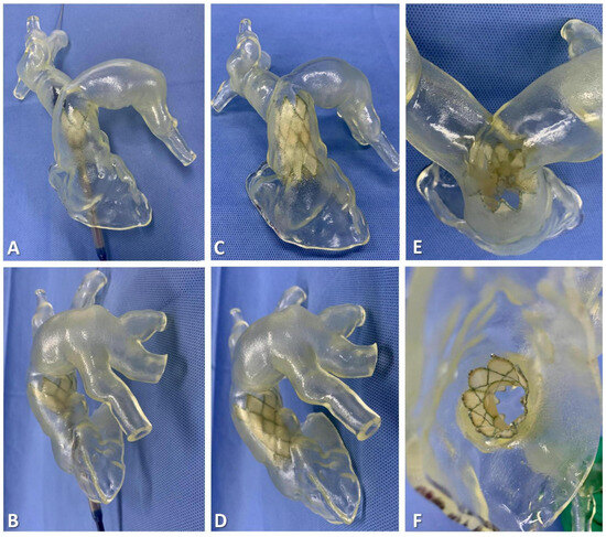 Treatment of Severe Pulmonary Regurgitation in Enlarged Native Right Ventricular Outflow Tracts ...