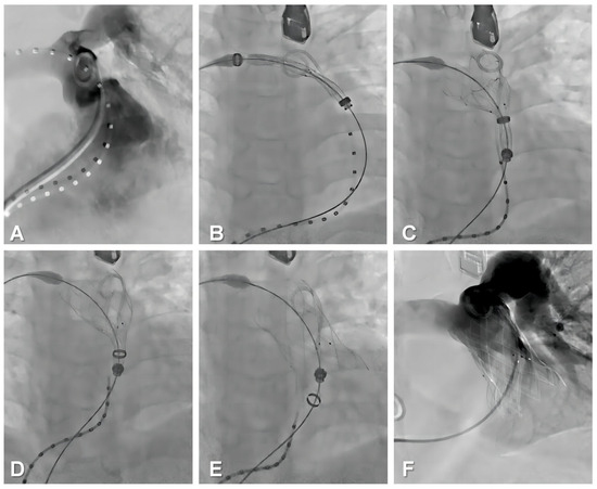 Treatment of Severe Pulmonary Regurgitation in Enlarged Native Right ...