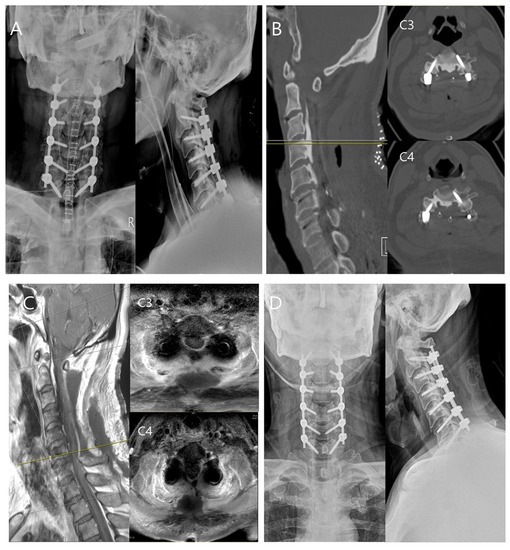 Effectiveness of Toothbrushing Technique for Biofilm Removal and ...