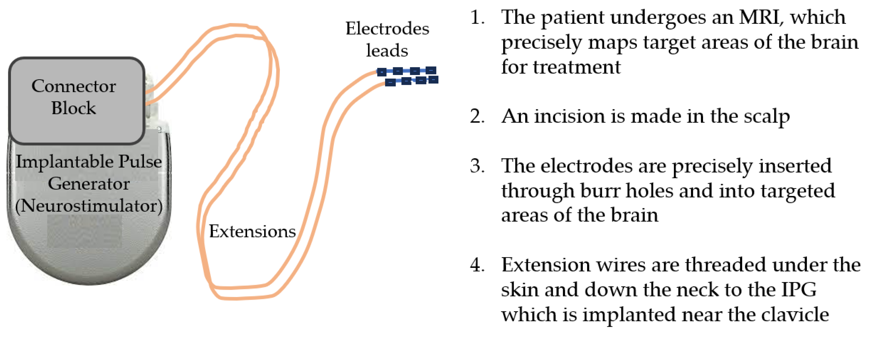 Investigation of a Deep Brain Stimulator (DBS) System