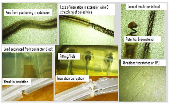 Investigation of a Deep Brain Stimulator (DBS) System