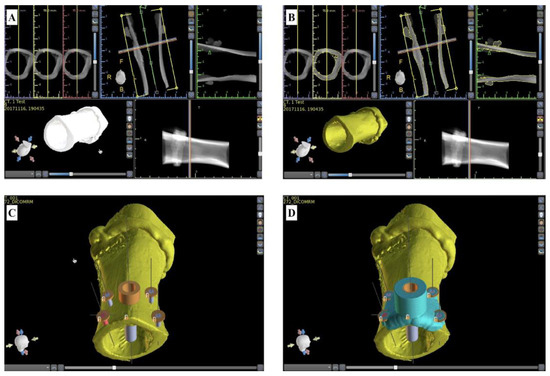 The 3D Printing and Evaluation of Surgical Guides with an Incorporated ...
