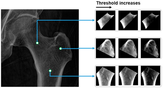 Bioengineering | Free Full-Text | Enhancement of Hip X-ray with Convolutional Autoencoder for ...