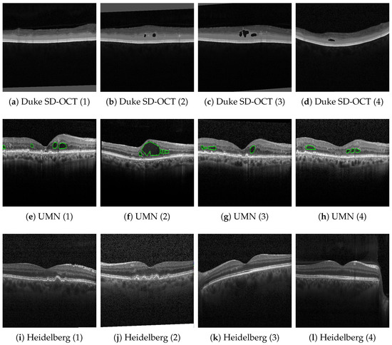 Improving OCT Image Segmentation of Retinal Layers by Utilizing a Machine Learning Based ...