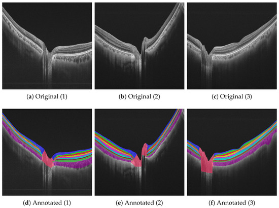 Improving OCT Image Segmentation of Retinal Layers by Utilizing a ...