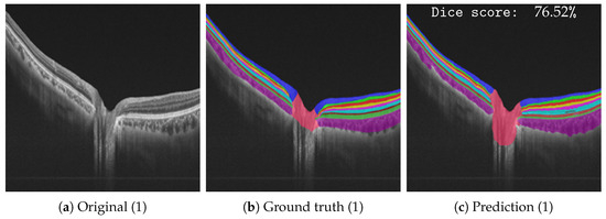 Improving OCT Image Segmentation of Retinal Layers by Utilizing a ...
