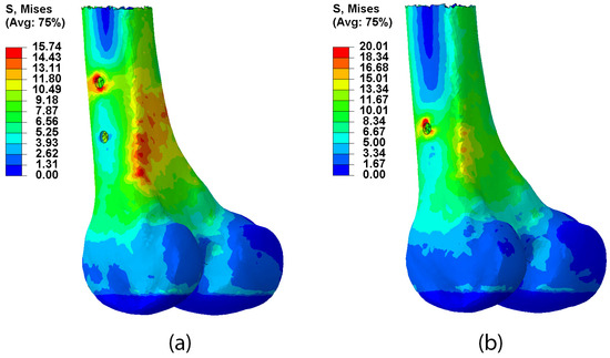 Biomechanical Behavior of Dynamic vs. Static Distal Locking ...