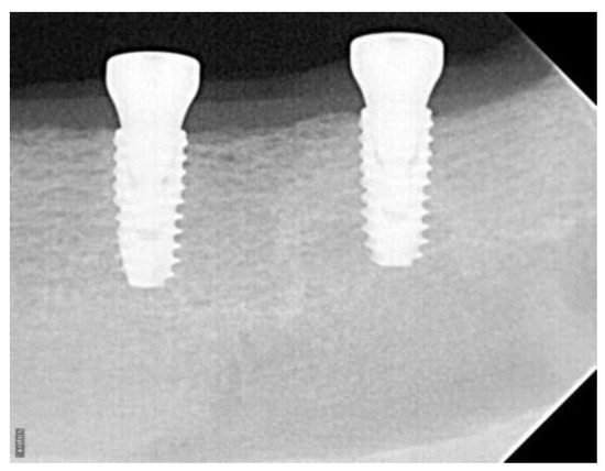 Gas Plasma Treatment Improves Titanium Dental Implant Osseointegration ...