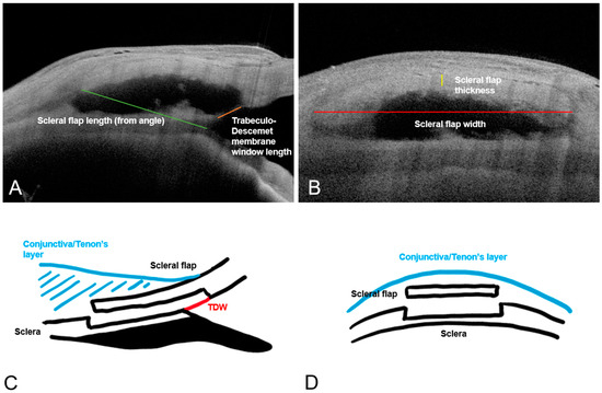 Swept-Source Anterior Segment Optical Coherence Tomography Imaging and ...