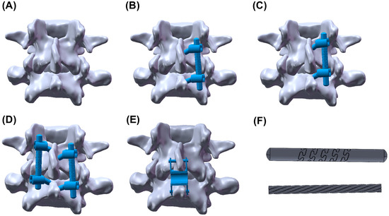 Treatment of Lumbar Degenerative Disease with a Novel Interlaminar ...