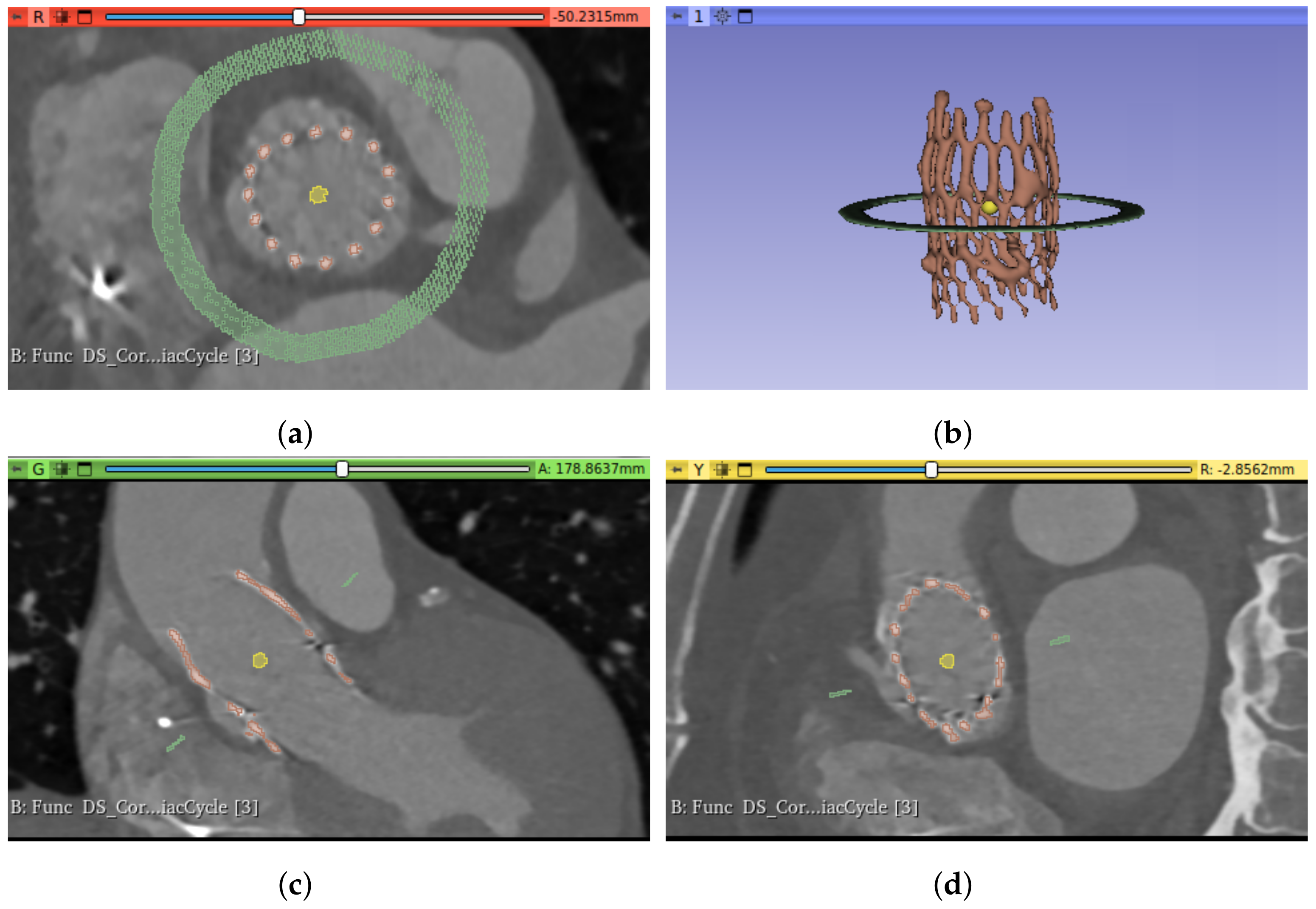 Automatic Assessment of Transcatheter Aortic Valve Implantation Results ...