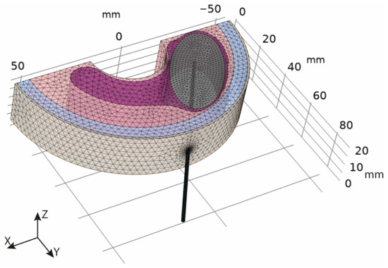 Model-Optimizing Radiofrequency Parameters of 3D Finite Element Analysis for Ablation of Benign ...