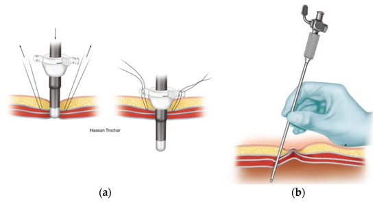Mechanical Characterization of the Human Abdominal Wall Using Uniaxial ...