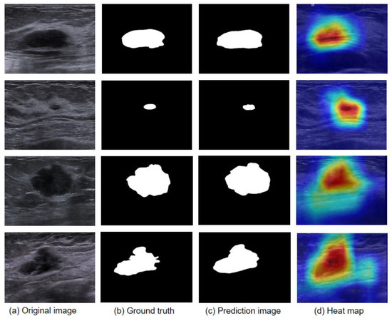 Rapid Segmentation and Diagnosis of Breast Tumor Ultrasound Images at ...