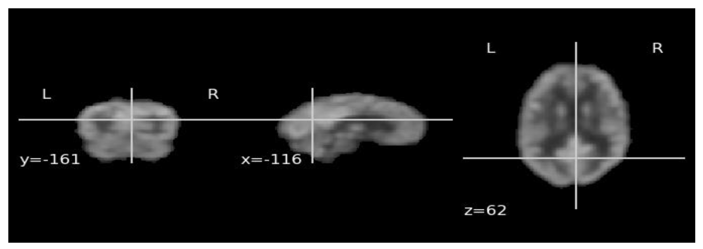 Explainable Vision Transformer with Self-Supervised Learning to Predict Alzheimer’s Disease ...