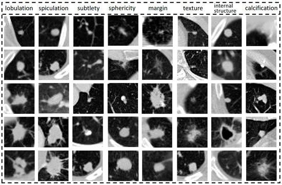 A Synthesizing Semantic Characteristics Lung Nodules Classification Method Based on 3D ...
