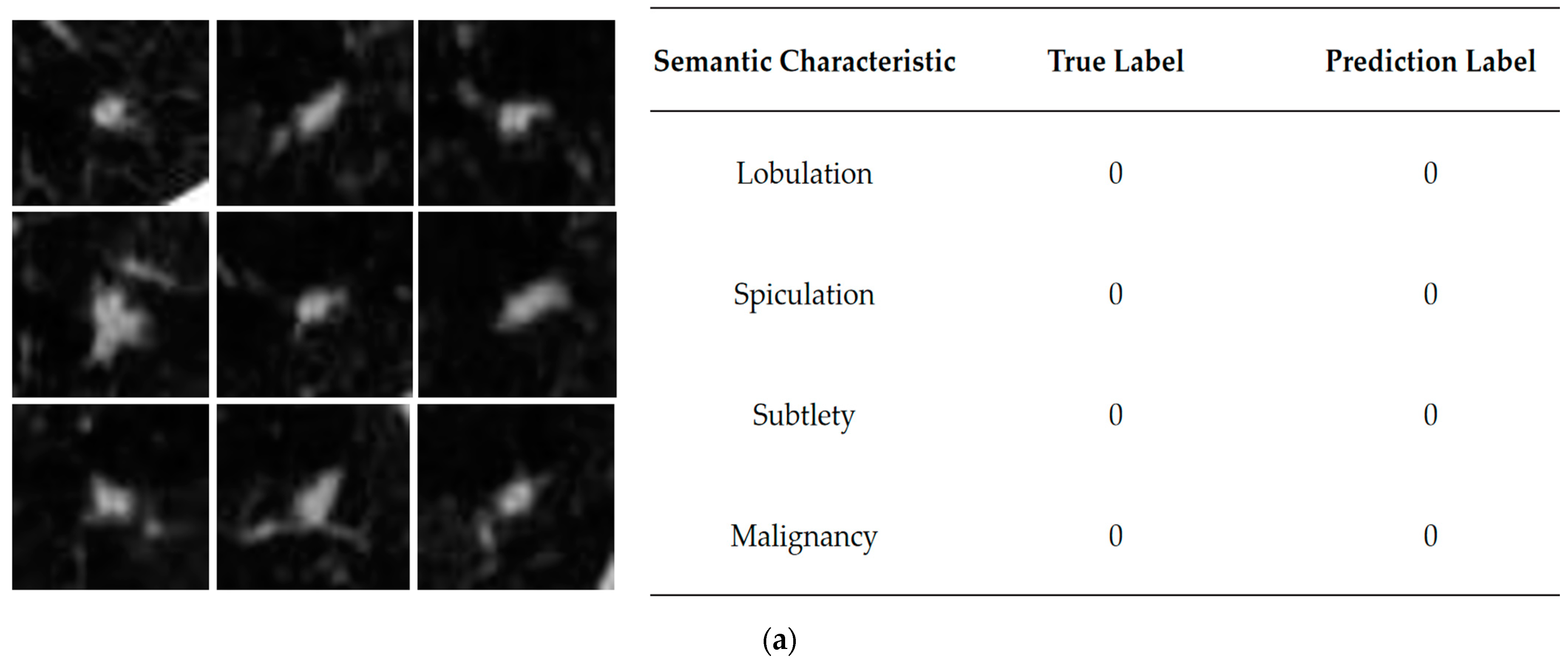 A Synthesizing Semantic Characteristics Lung Nodules Classification Method Based on 3D ...