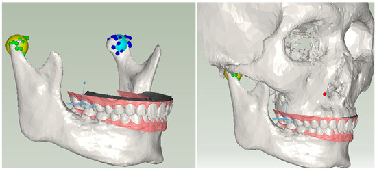 Virtual Dental Articulation Using Computed Tomography Data and Motion ...